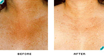 Age Spots And Sun Damage - Laser Cosmetic Clinic